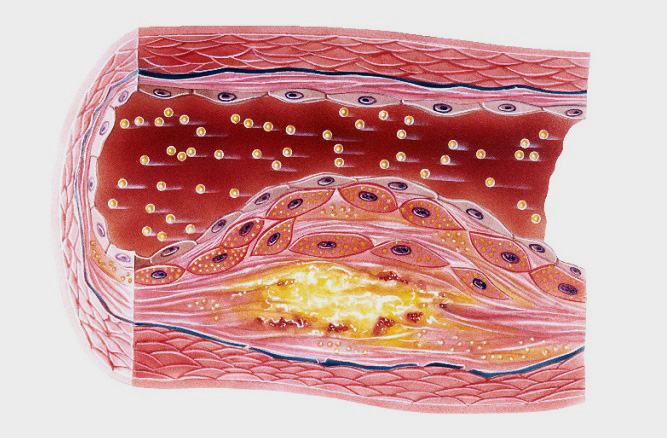 Lipid-Rich Plaque in Nonculprit Regions of the Target Vessel Predicts ...