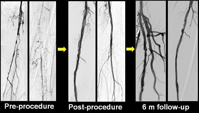 Lower Limb Revascularizations Increasing in PAD Patients on Dialysis ...