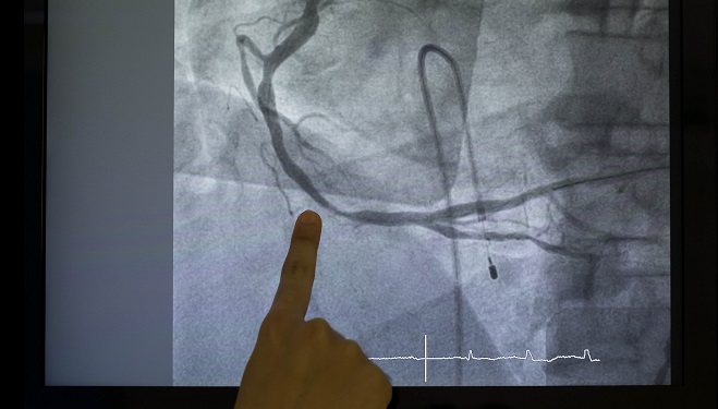 RECAP: In the Cath Lab, a Lead-free Pad Placed on the Patient Cuts ...