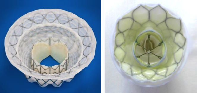 Early Pilot Study Results Show Symptom Improvement With TMVR | tctmd.com