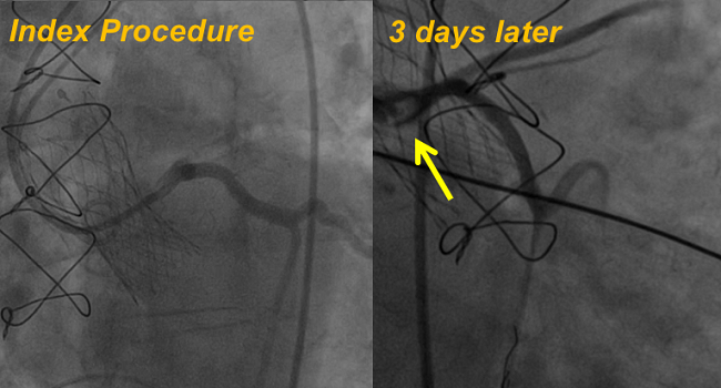 Delayed Coronary Obstruction After TAVR: Prevalence, Causes, and ...