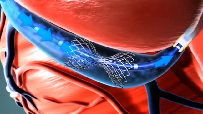 Positive Real-World Results for Coronary Sinus Reducer in Patients With ...