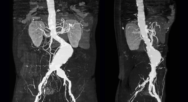 FDA: All AFX Endovascular AAA Systems Now Under Class I Recall | tctmd.com