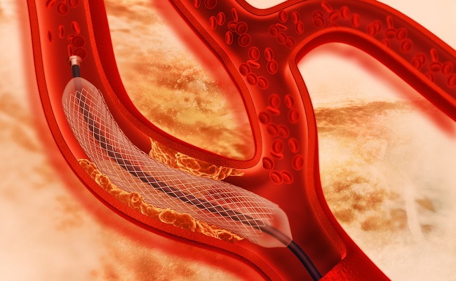 New-Generation DES Better Than Older Stents Over 10 Years, Regardless ...