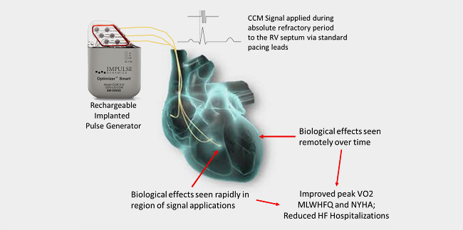FDA Approves the Optimizer Smart Implantable Pulse Generator for Heart ...