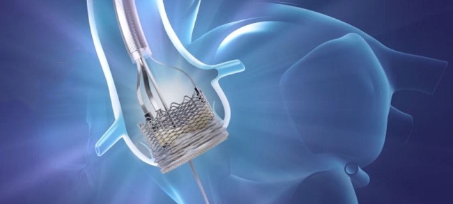 FDA Approves Lotus Edge, Ushering Third Device Into US Market | tctmd.com