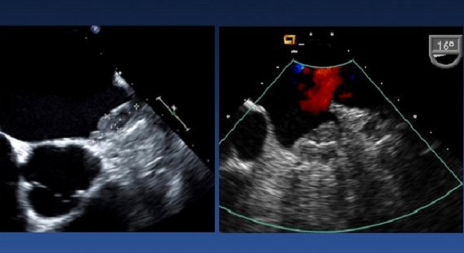Device-Related Thrombus and LAA Closure: Rare but Dangerous | tctmd.com