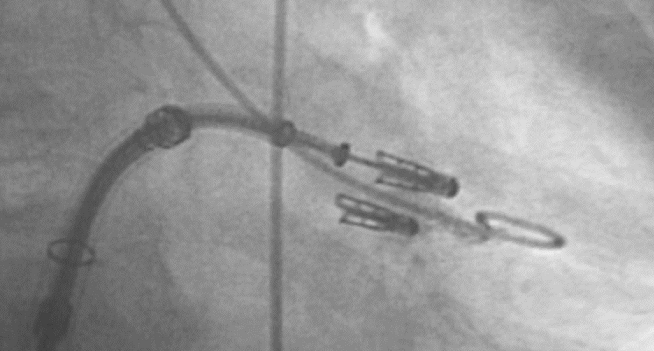 Better Outcomes, Fewer Complications Among Higher-Volume MitraClip ...