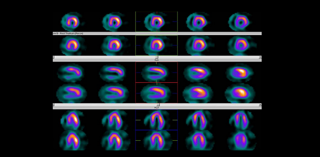 STICH Myocardial Viability at 10 Years: Still No Link With CABG Effects ...