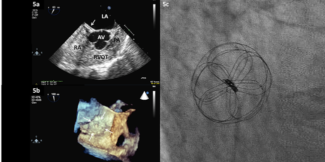 Better Closure, More A-fib With Cardioform for PFO Closure ...