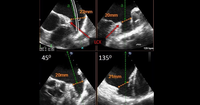 Watchman Adverse Events: Analysis Digs Into What’s Been Reported to the ...
