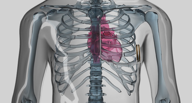 Subcutaneous ICD Holds Up Well Against Transvenous Devices | tctmd.com