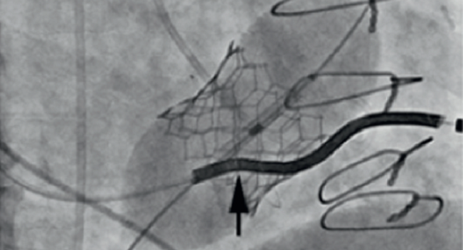 When a Pacemaker Lead Complicates Transcatheter Tricuspid Replacement ...