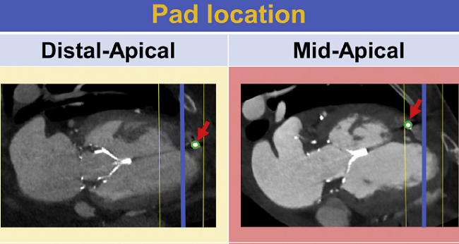 Implantation Technique Influences LV Remodeling After TMVR | tctmd.com