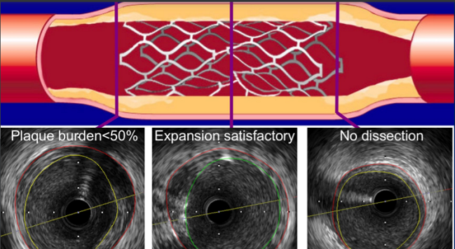 IVUS-Guided PCI Gains Support With Longer-Term ULTIMATE Results | tctmd.com
