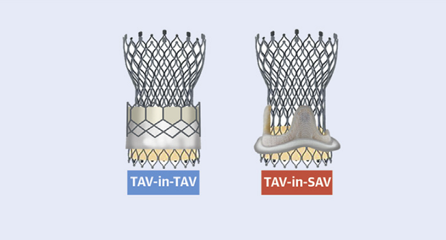 TAVR Yields Similar Success in Failed TAVR or Surgical Valves | tctmd.com