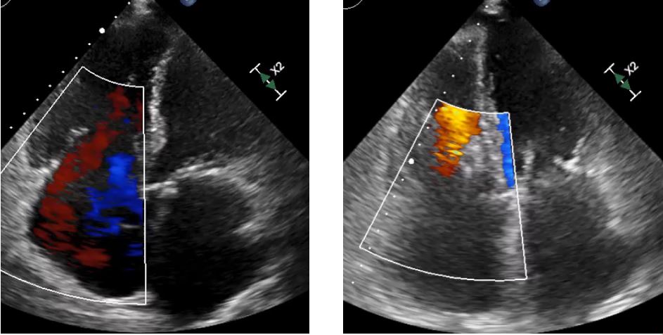 Pascal Device Works Well for Tricuspid Regurgitation in Commercial ...