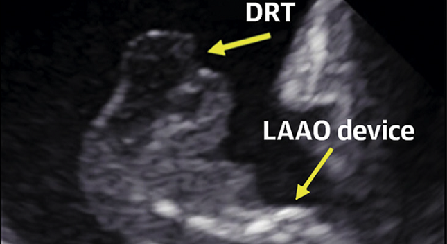 Predictors of Device-Related Thrombus Following LAA Occlusion | tctmd.com