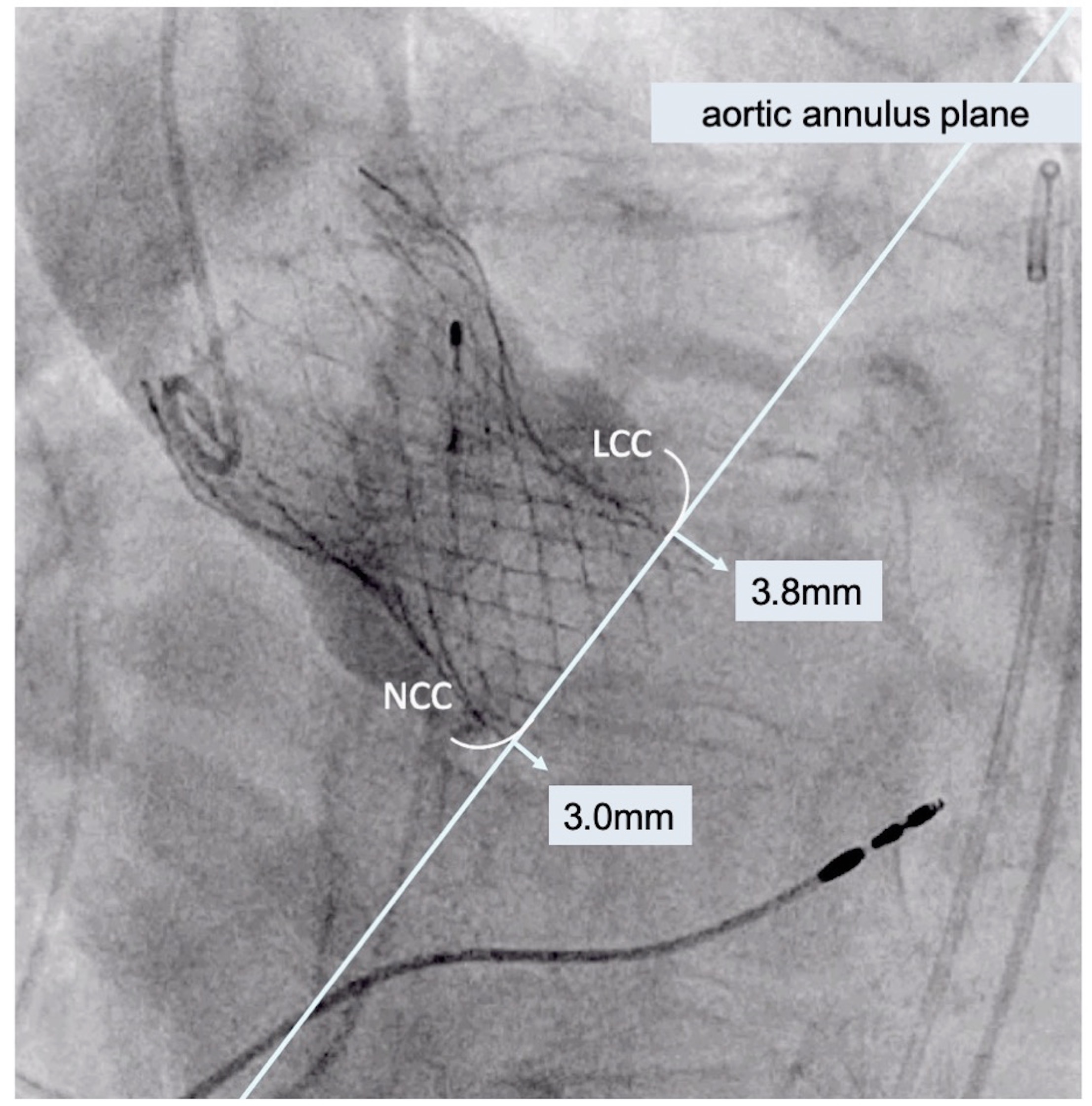Optimal Implantation Depth With Self-Expanding TAVR? Success May Prove ...