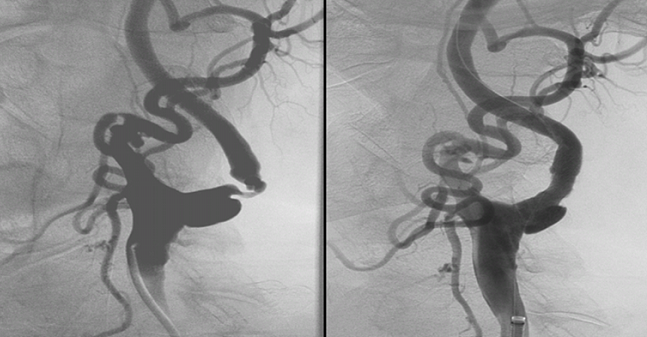 Plaque Protrusion an Infrequent but Troubling Complication of Carotid ...