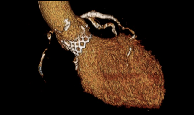 New CT Guidelines for TAVR Emphasize Standardization, 4-D Acquisition ...