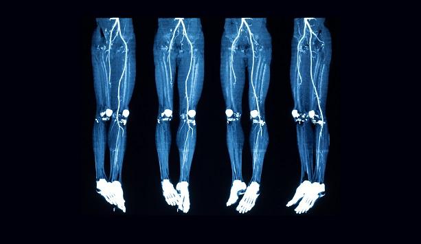 PVI in Symptomatic Lower-Extremity PAD Offers Multiple Benefits, Even 2 ...