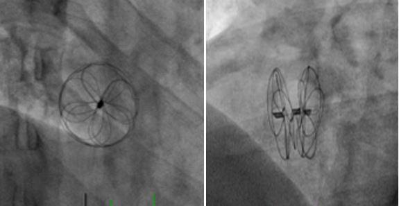 First US Consensus Statement on PFO Closure Addresses Volume ...