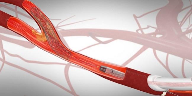 TCAR Use Growing for Carotid Stenosis as Positive Data Continue to ...