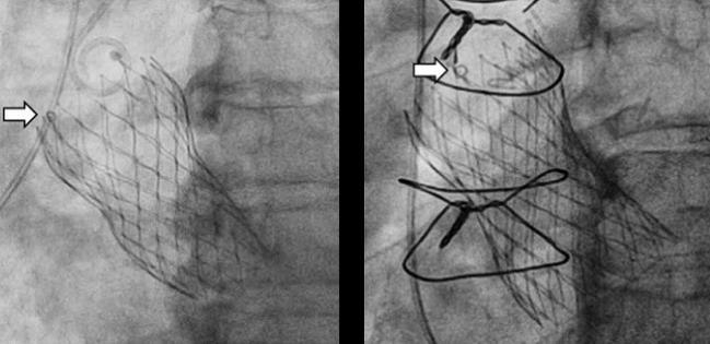 Evolut Valves: Initial Positioning Can Be Optimized for Future Coronary ...