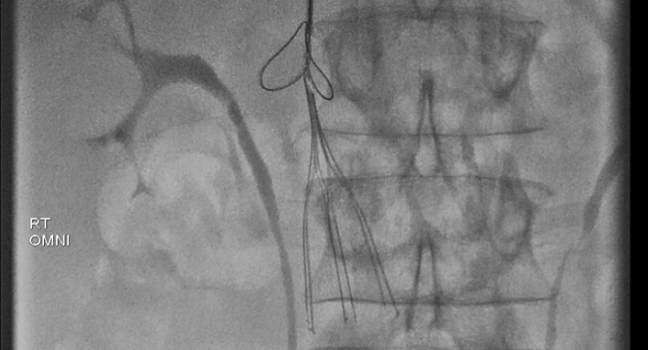 Use of IVC Filters for DVT Peaked in 2010 but Remains High | tctmd.com