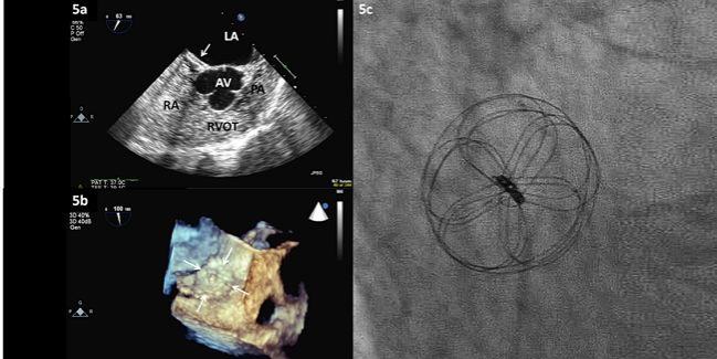 Better Closure, More A-fib With Cardioform for PFO Closure ...