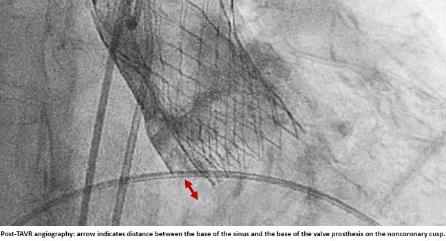 Optimal Implantation Depth With Self-Expanding TAVR? Success May Prove ...