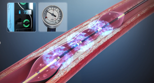 DISRUPT CAD III: Lithotripsy Boosts Stent Expansion in Highly Calcified ...