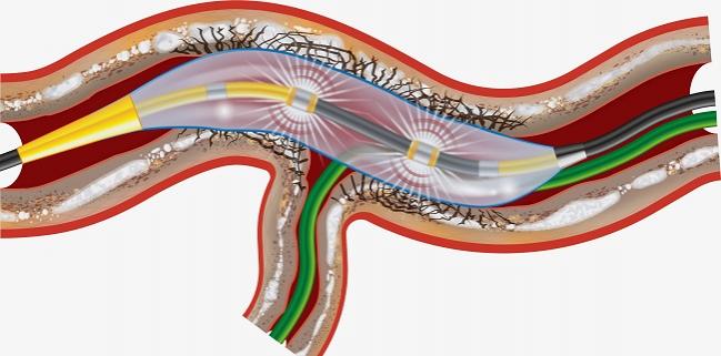 FDA Approves Shockwave Intravascular Lithotripsy for Calcified ...