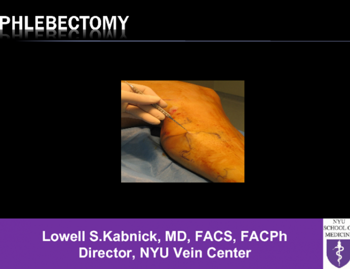Phlebectomy | tctmd.com
