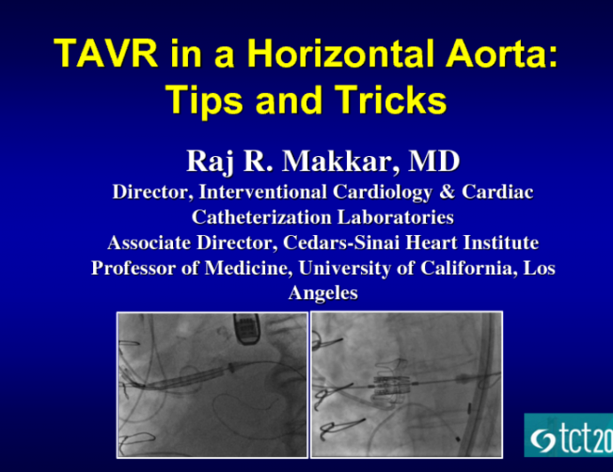 TAVR in a Horizontal Aorta: Tips and Tricks (With a Case) | tctmd.com
