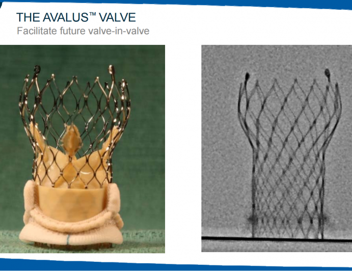 Avalus Aortic Bioprosthesis | tctmd.com
