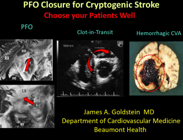 PFO Closure for Cryptogenic Stroke Choose your Patients Well | tctmd.com