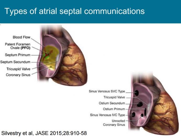 Guidelines: Assessment of ASD and PFO and Evaluation of a Cardiac ...