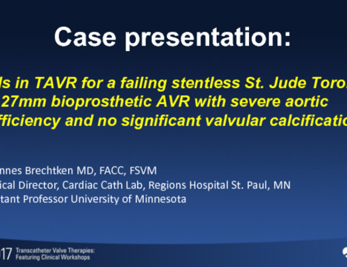 Pitfalls in TAVR for Failing Stentless St. Jude Toronto 27mm ...