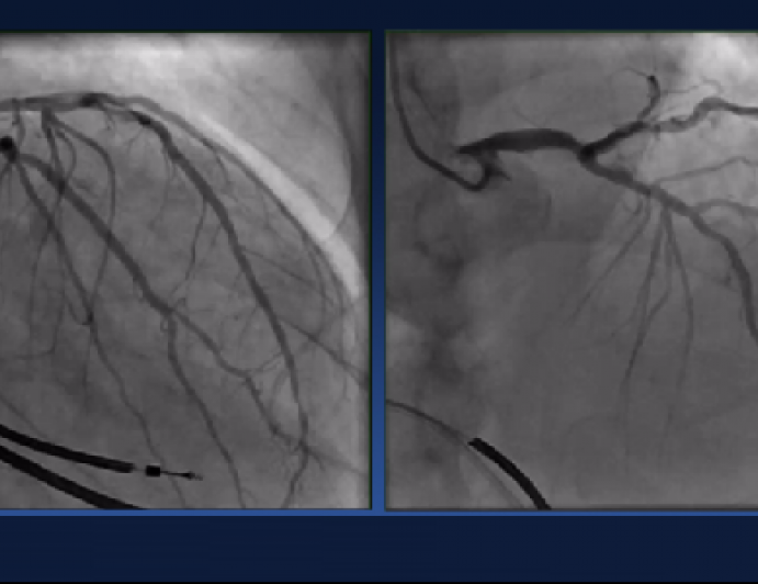 CABG vs PCI vs Mechanical Support | tctmd.com