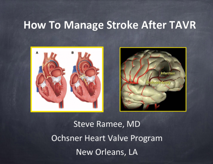 How to Manage a Stroke After TAVR | tctmd.com