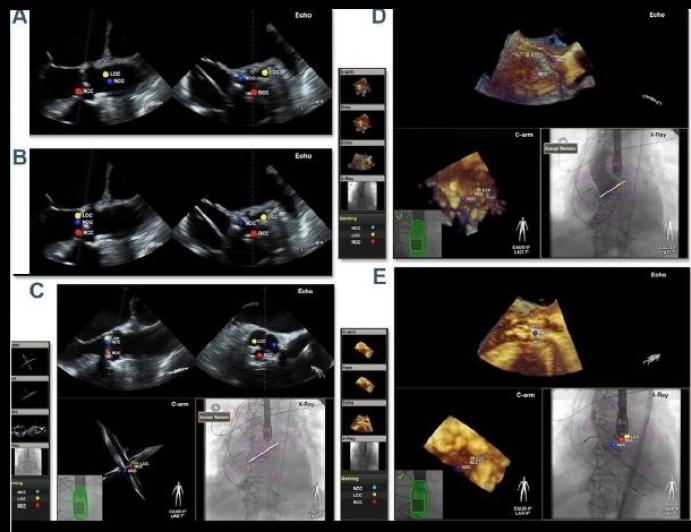 Echocardiographic Imaging for TAVR | tctmd.com