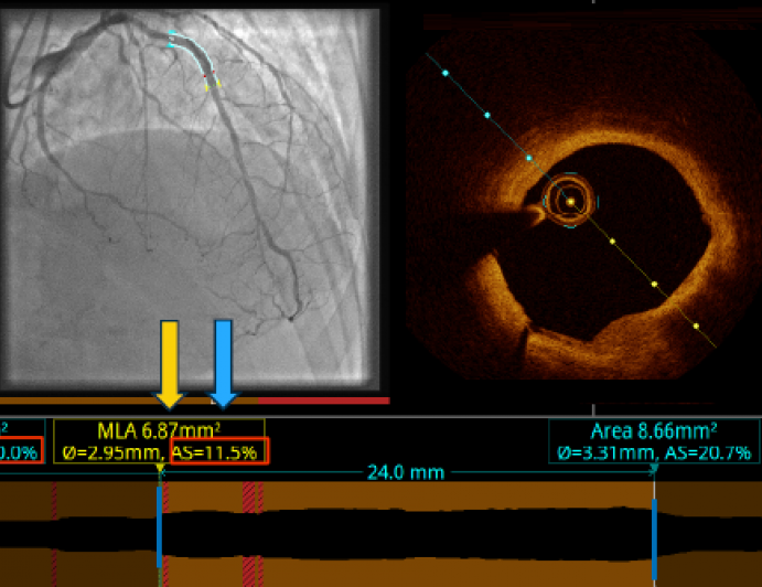 OCT, IVUS, FFR, iFR (NHPR): Which Technology When? | tctmd.com