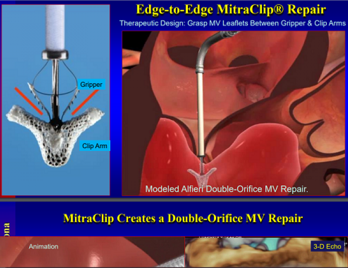 My Most Complex Transcatheter Mitral Valve Case (Recently) | tctmd.com