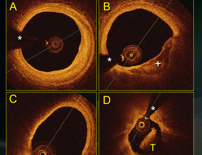 Que nos ha Enseñado la OCT de la Patofisiología del Síndrome Coronario ...