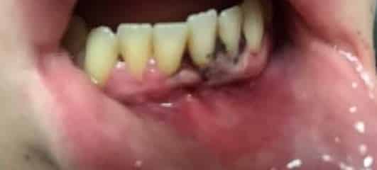 Gingival and alveolar bone necrosis following chin augmentation with ...