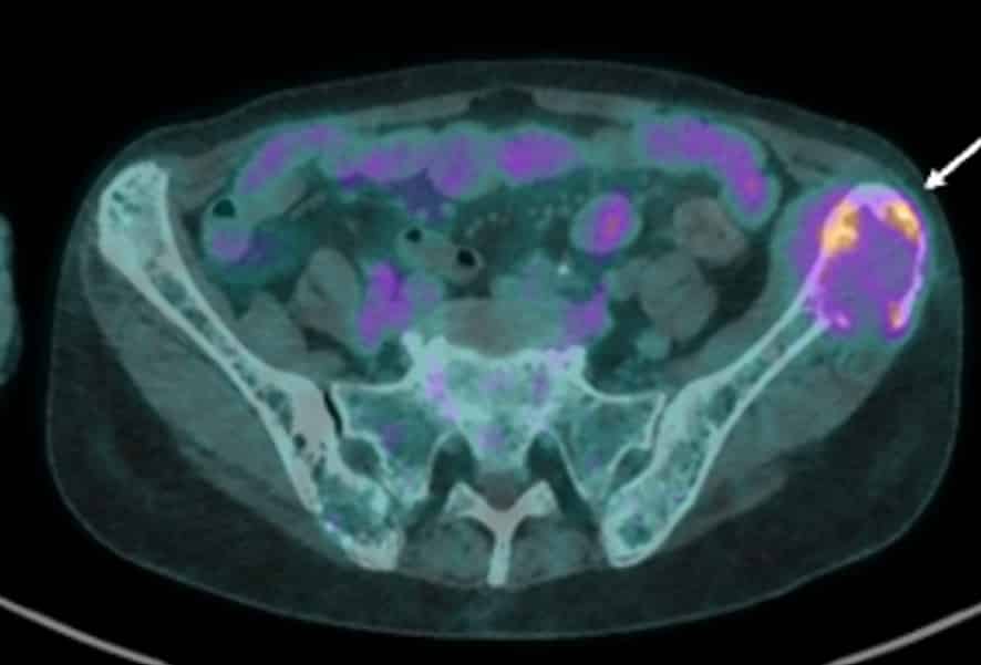 Elranatamab treatment in a multiple myeloma patient undergoing renal ...