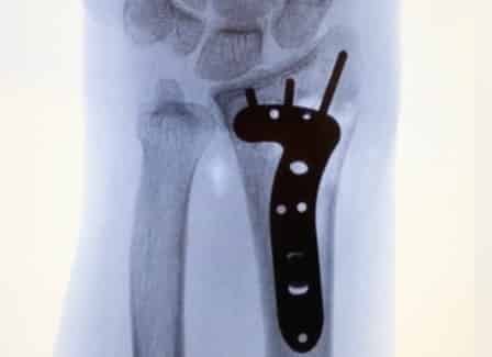 Volar Locking Plate Fixation of Distal Radius Fractures: A Surgical ...