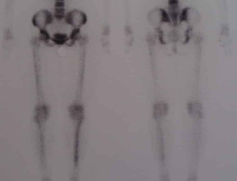 Diagnosis of Shin Splint: A Case Report | Published in SurgiColl